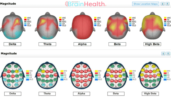 Sample of a portion of a typical Michigan Brain Health qEEG Report ...